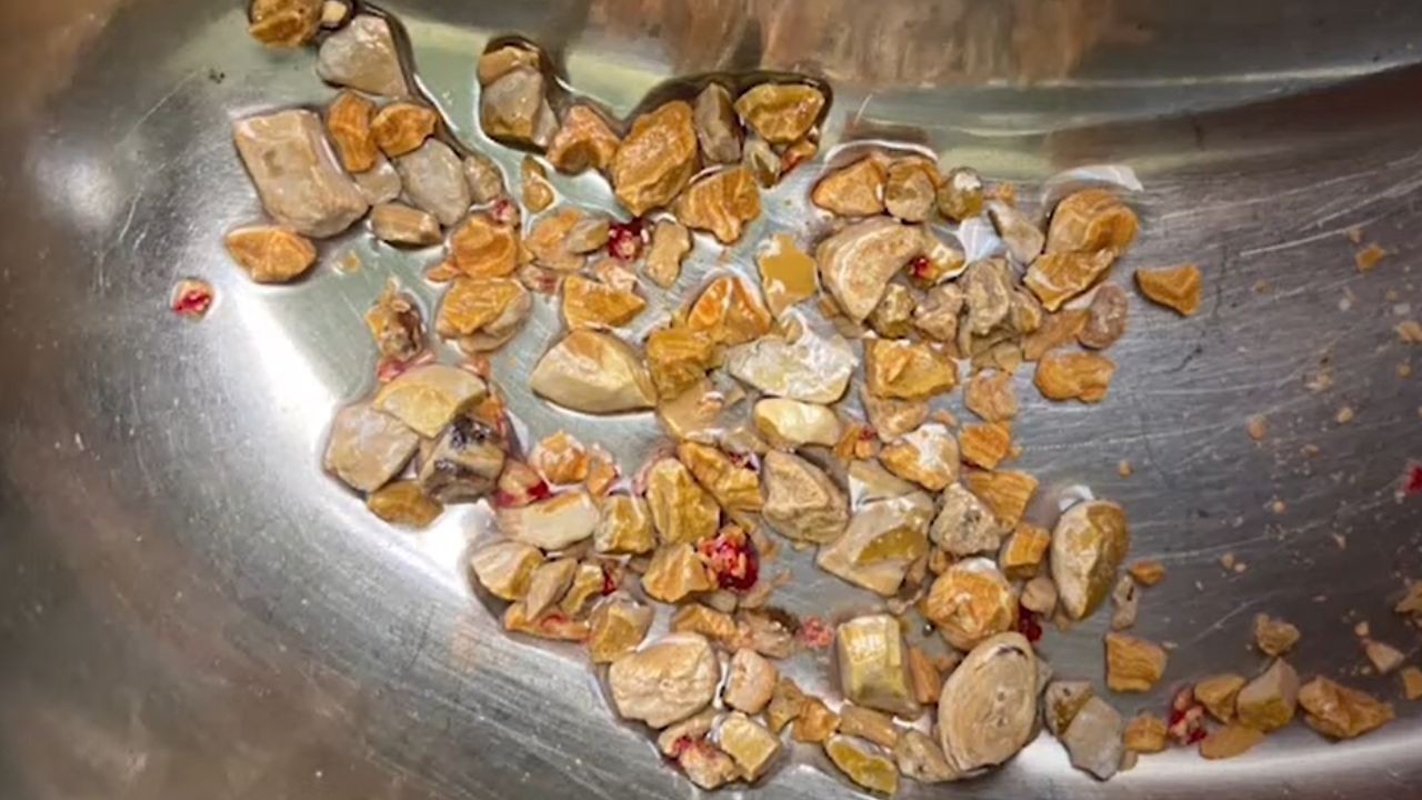 Calorão vira “fábrica” de pedra nos rins: por que o verão aumenta o risco